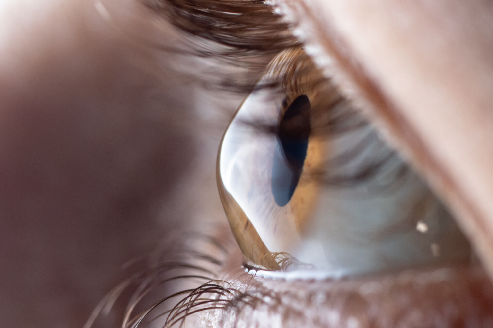 Keratoconus: how to recognize symptoms and causes - Emianopsia